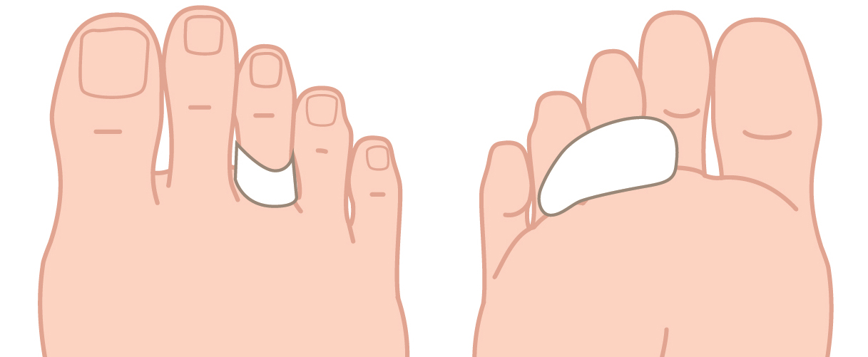 T is for Toe Crest - SOLO Labs